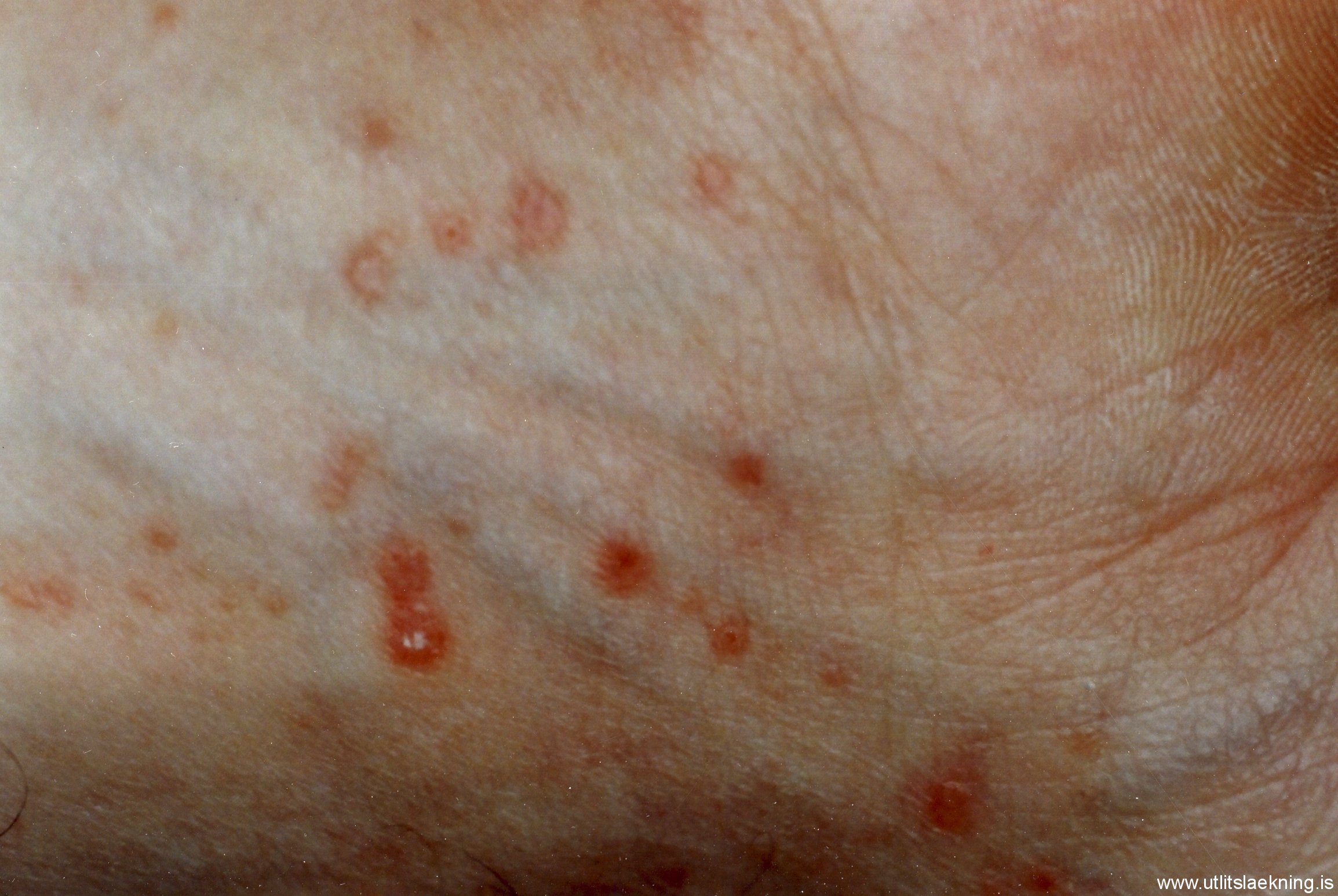 Flatsk ningur lichen Planus tlitsl kning